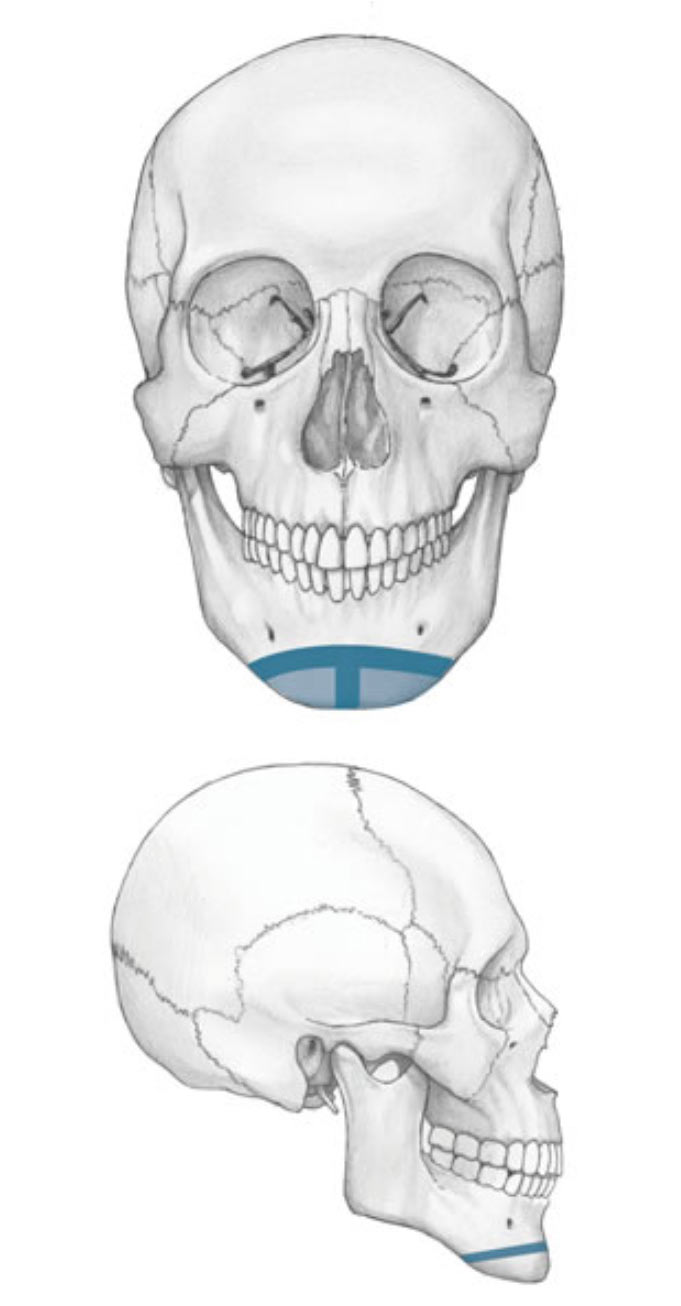 Chin correction - 2pass Clinic