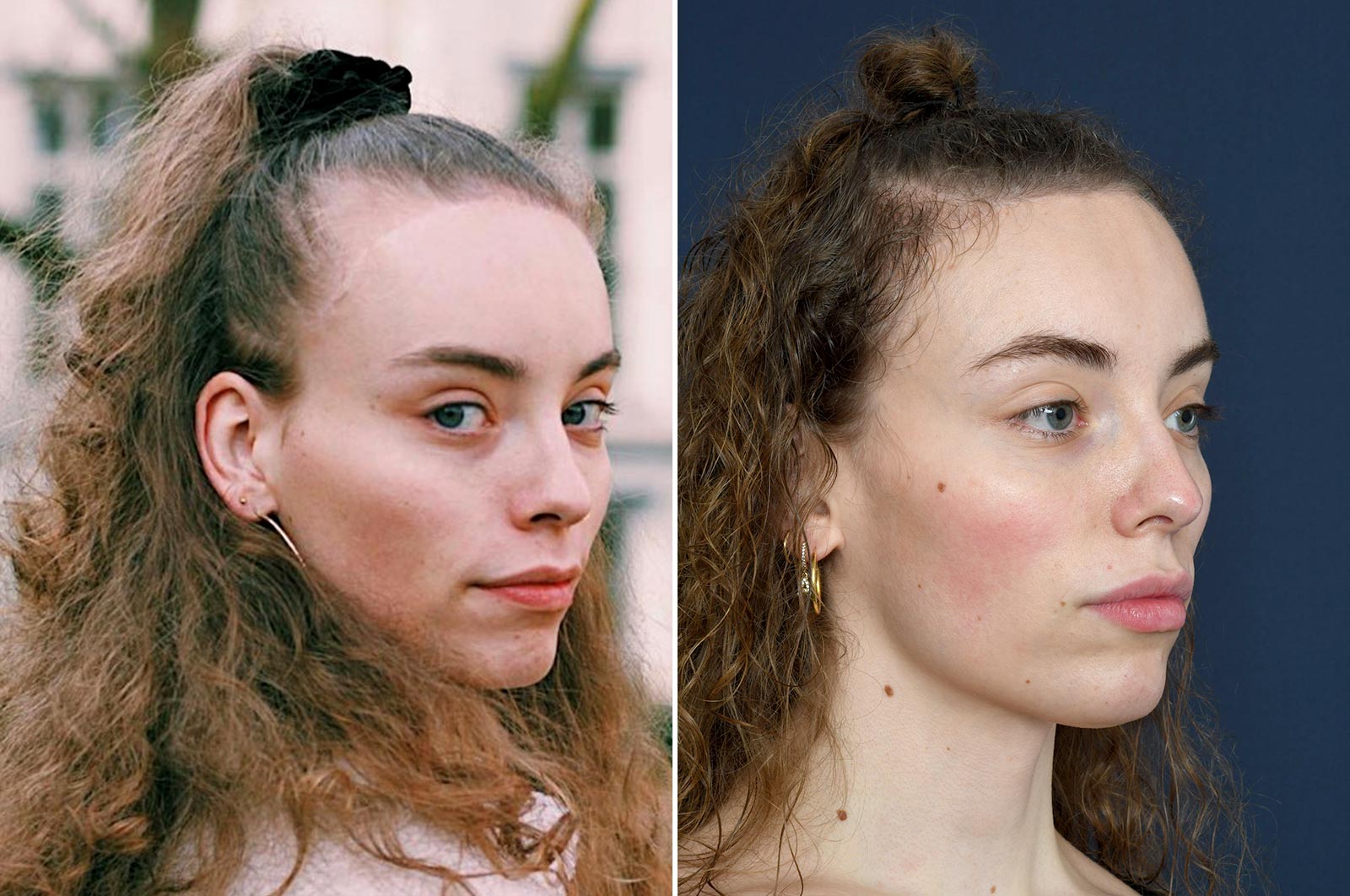 Hair transplantation - 2pass Clinic