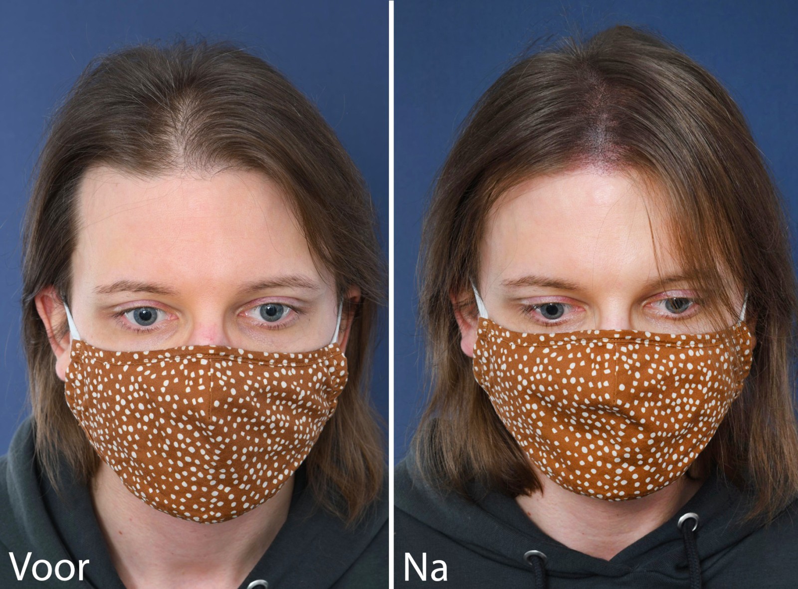 What is micro hair pigmentation? - 2pass Clinic