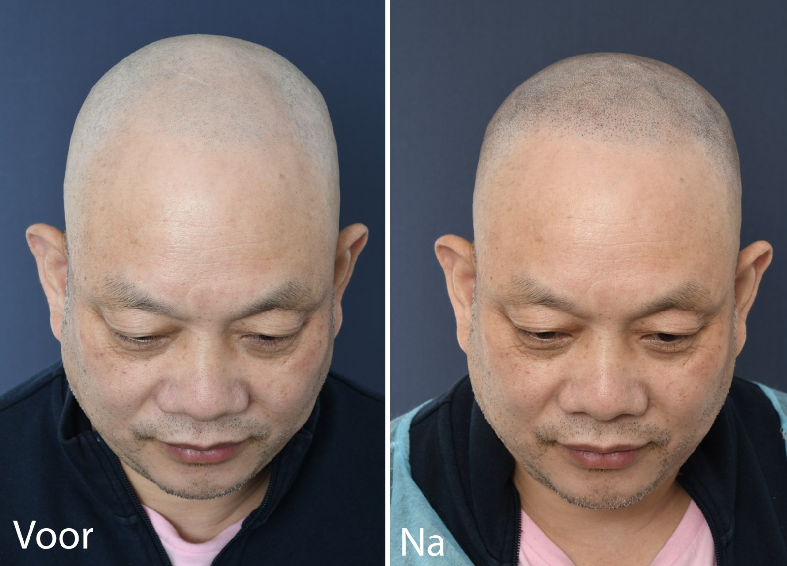 What is micro hair pigmentation? - 2pass Clinic